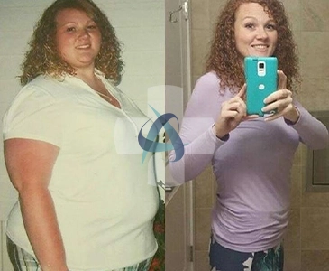 Single Incision Laparoscopic: Costs and Surgery Details